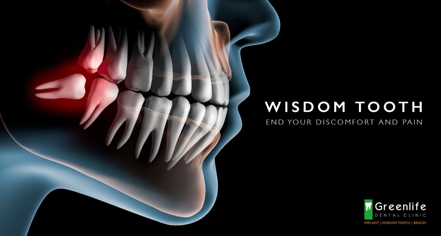 Wisdom Tooth | Greenlife Dental